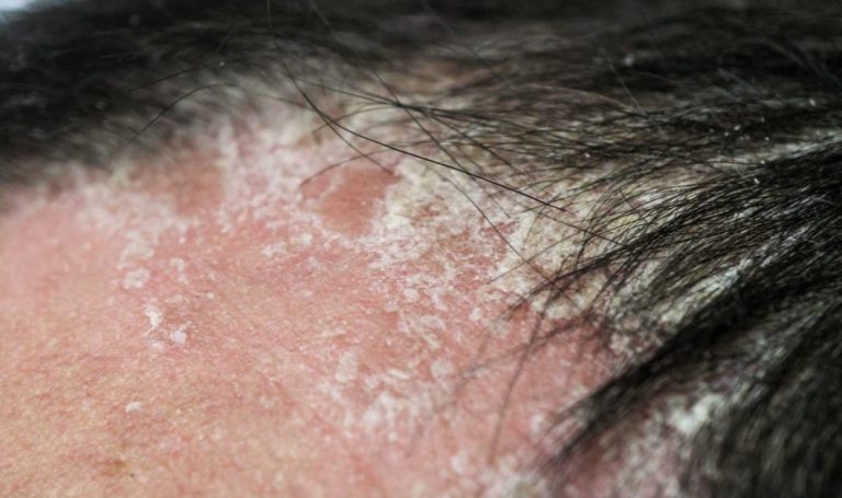 Psoriasis cheveux : comment traiter le psoriasis du cuir chevelu?